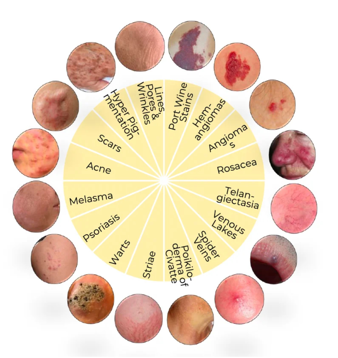 アドバンテックス（ADVATx）｜神戸初の赤み・ニキビ・皮脂治療